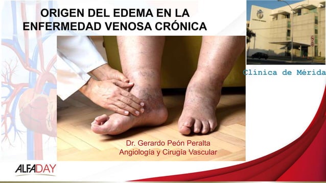ORIGEN DEL EDEMA EN LA ENFERMEDAD VENOSACRONICA. pptx | PPTX