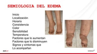ORIGEN DEL EDEMA EN LA ENFERMEDAD VENOSACRONICA. pptx | PPTX