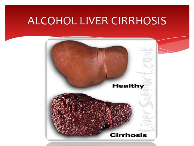 Cirrhosis As Related To Alcoholic Liver Disease Pictures