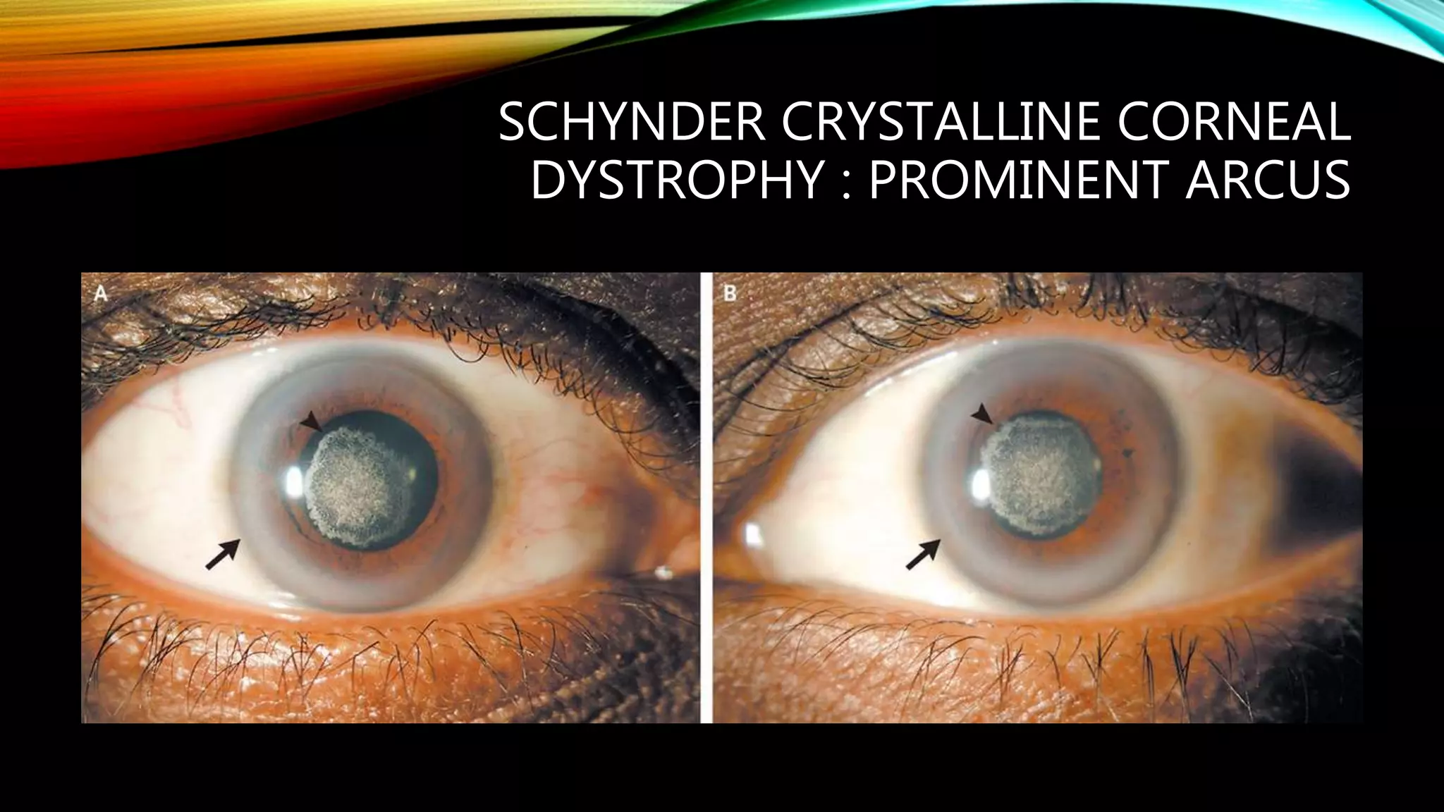 CORNEAL DYSTROPHIES | PPT