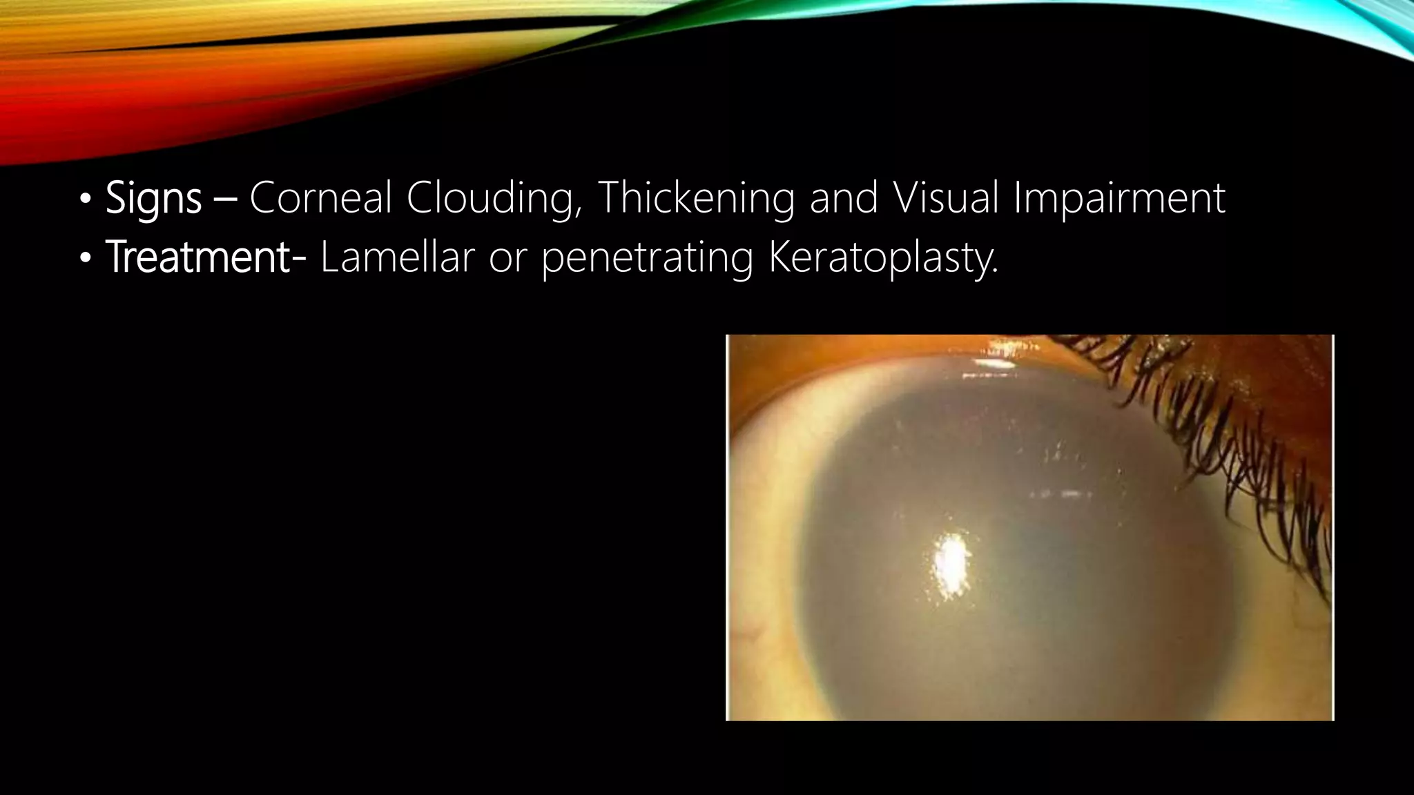CORNEAL DYSTROPHIES | PPT