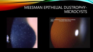 CORNEAL DYSTROPHIES | PPT