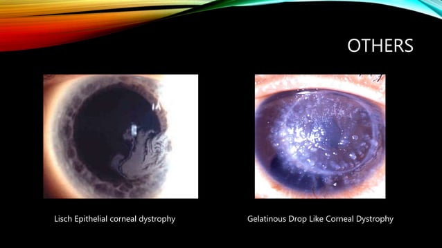 CORNEAL DYSTROPHIES | PPT