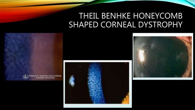 CORNEAL DYSTROPHIES | PPT