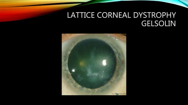 CORNEAL DYSTROPHIES | PPT