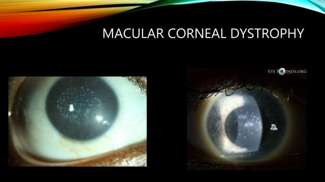 CORNEAL DYSTROPHIES | PPT