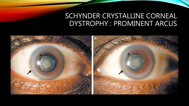CORNEAL DYSTROPHIES | PPT
