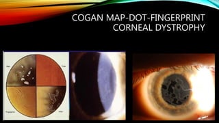 CORNEAL DYSTROPHIES | PPT