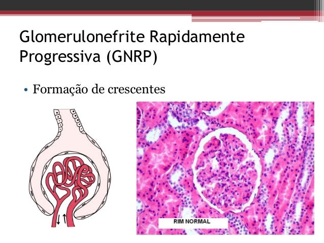 GLOMERULONEFRITE E SINDROME NEFRÓTICA