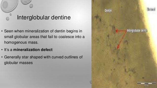 Interglobular Dentin