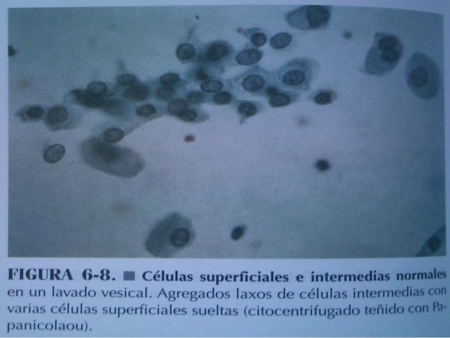 Que Son Las Celulas Transicionales En La Orina? – VBCTN