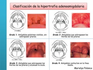 hipertrofia adenoamigdalar | PPTX