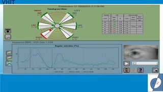 Vestibular neuritis | ODP