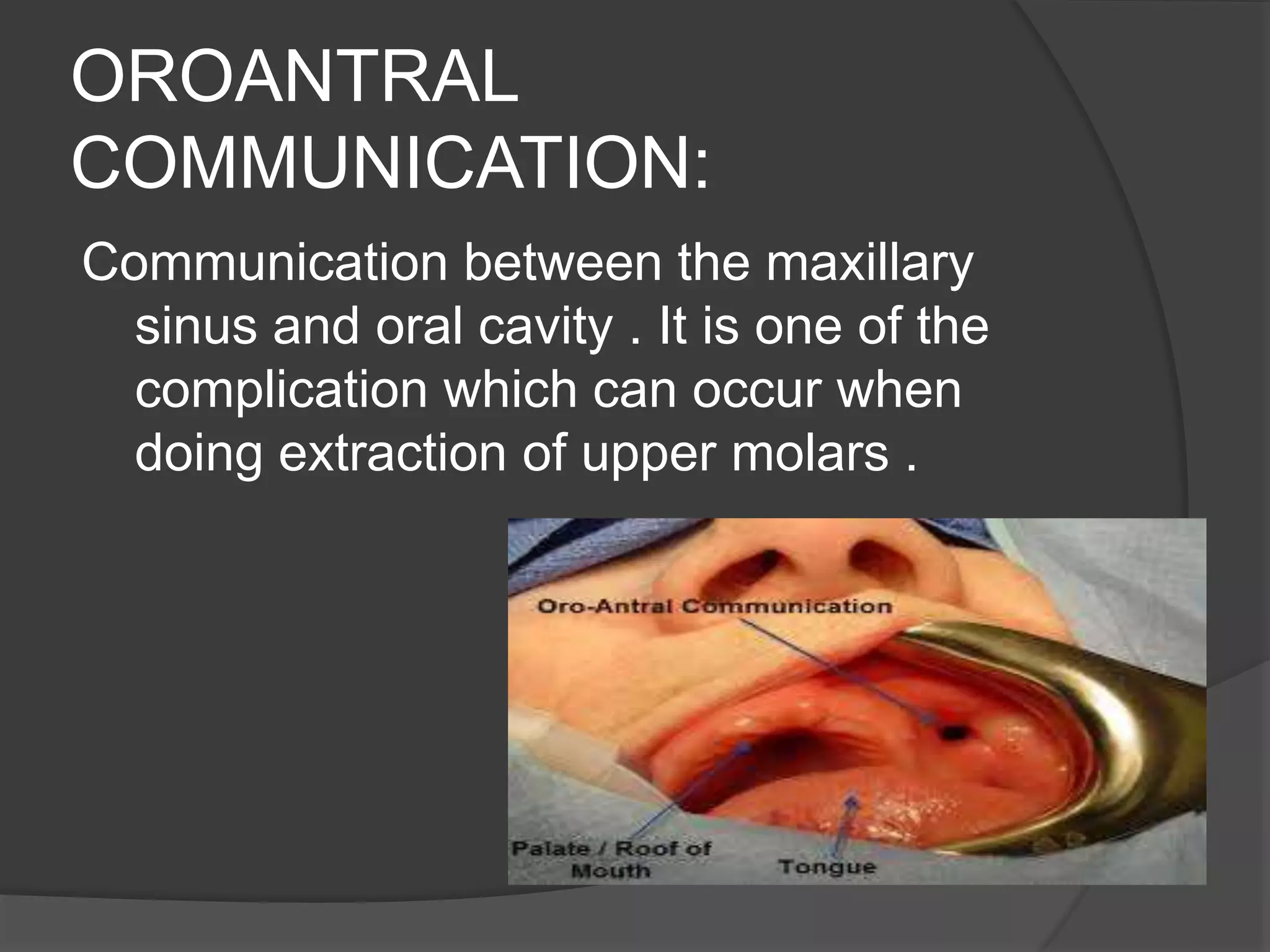 Oro antral communication | PPTX