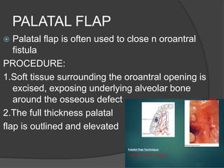 Oro antral communication | PPTX
