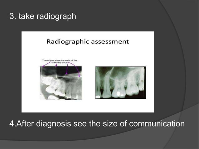 Oro antral communication | PPTX | Ear, Nose and Throat Conditions ...