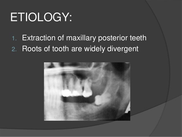 Oro antral communication