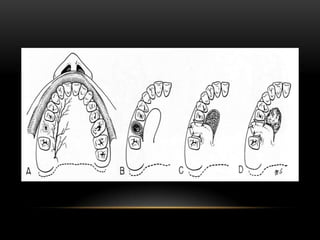 Oroantral communication | PPTX