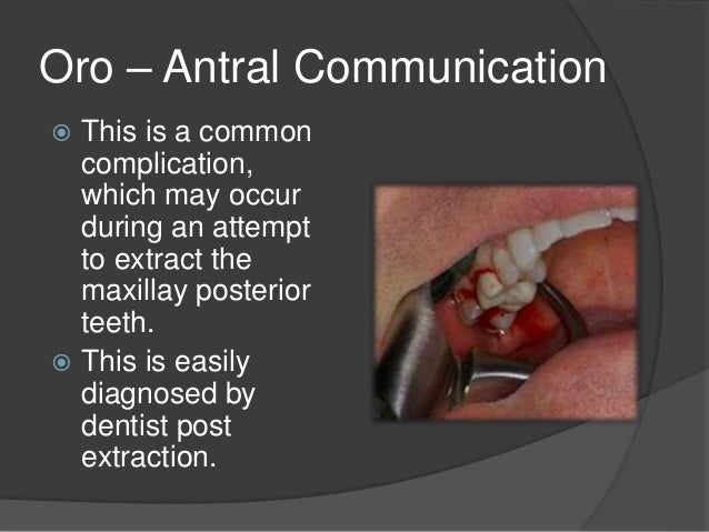 Oro – antral communication