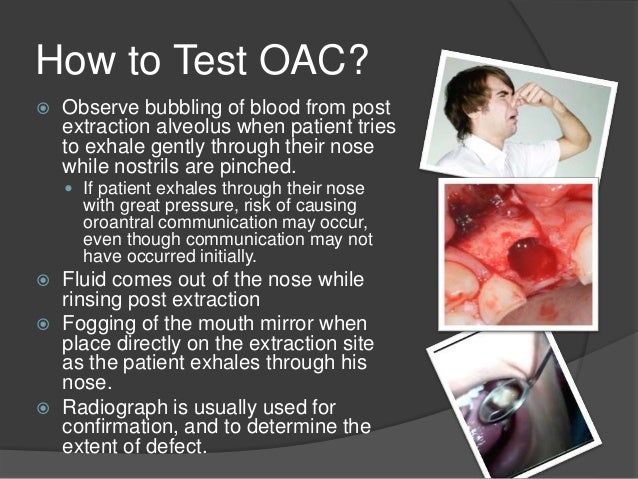 Oro – antral communication