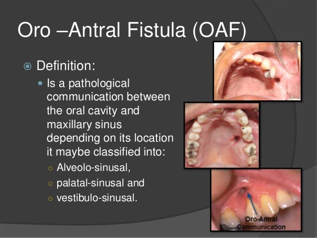 Oro – antral communication