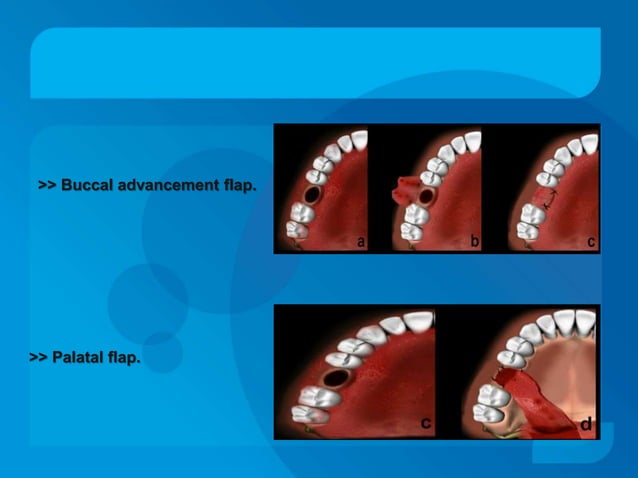 Oroantral Communication by assistant professor dr bayad jaza | PPT