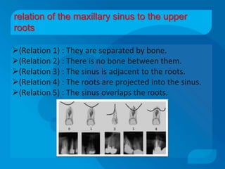 Oroantral Communication by assistant professor dr bayad jaza | PPT