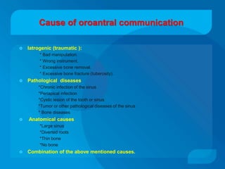Oroantral Communication by assistant professor dr bayad jaza | PPT