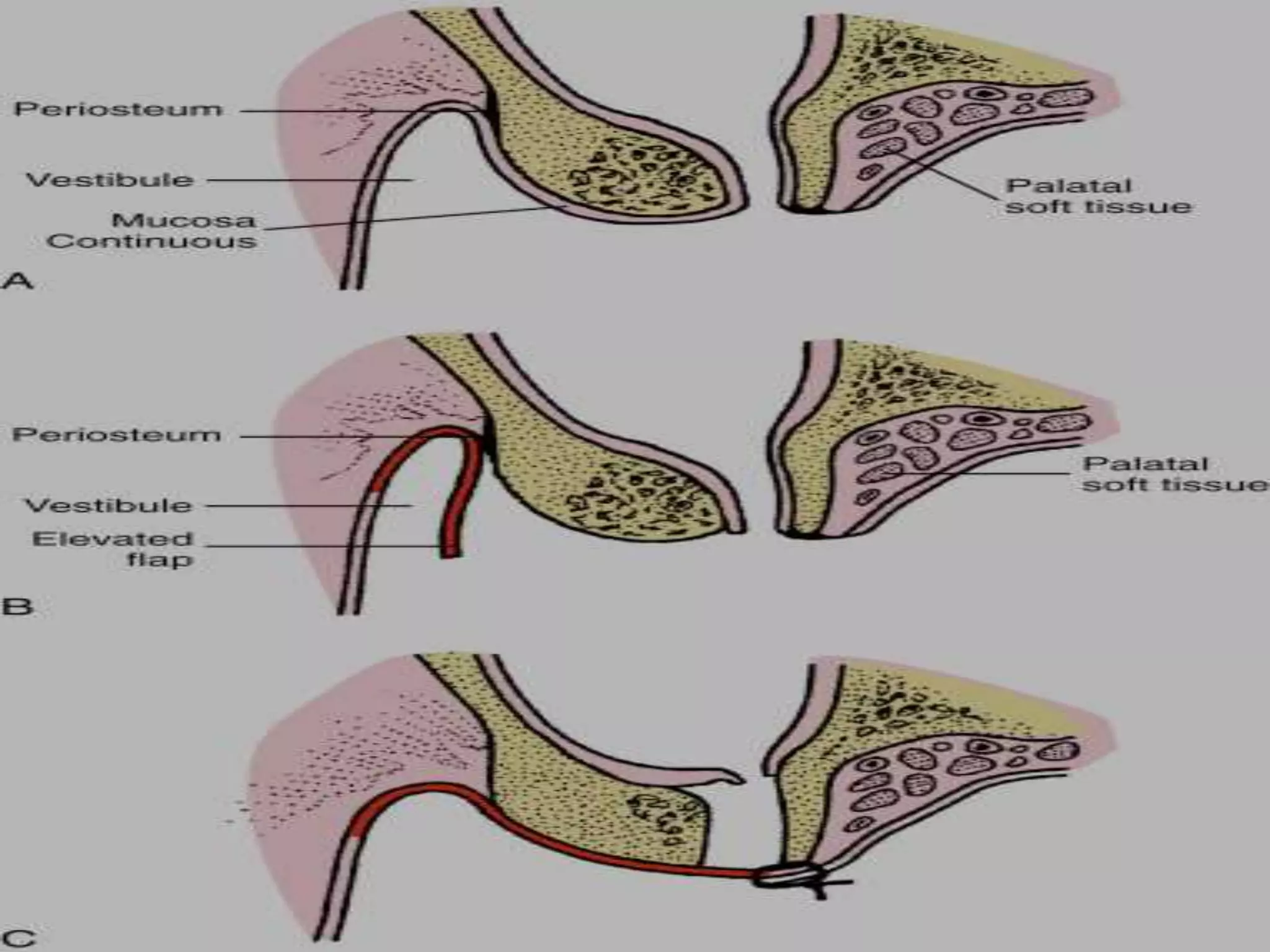 Oroantral communication and oroantral fistula | PPTX