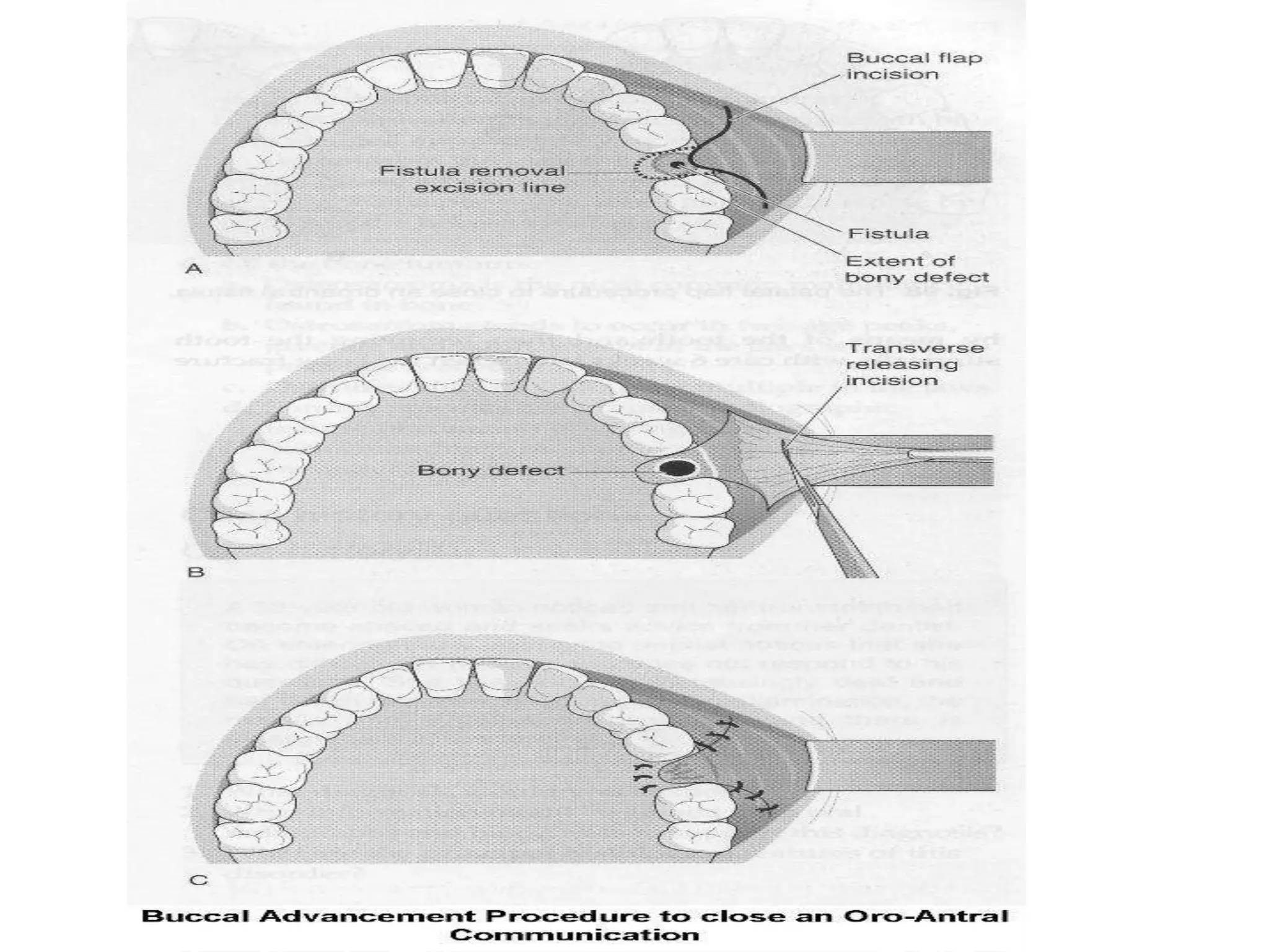 Oroantral communication and oroantral fistula | PPTX