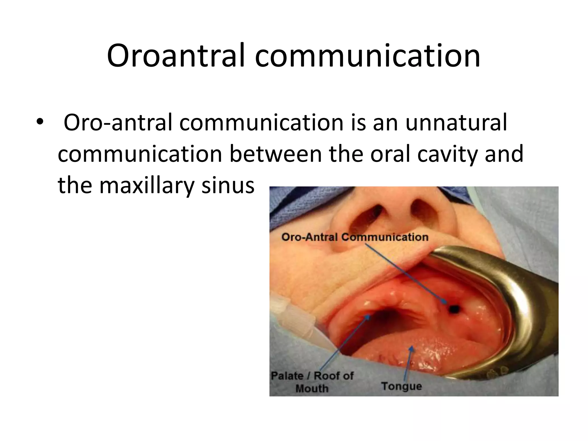 Oroantral communication and oroantral fistula | PPTX