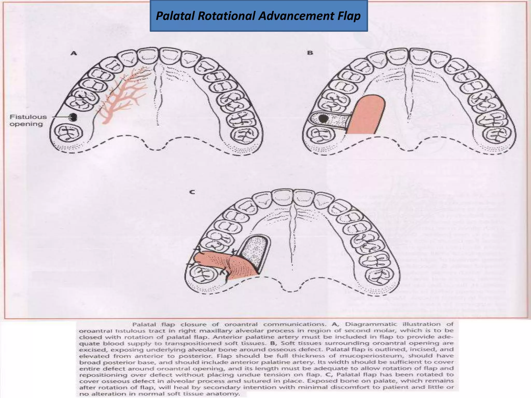 Oroantral communication and oroantral fistula | PPTX