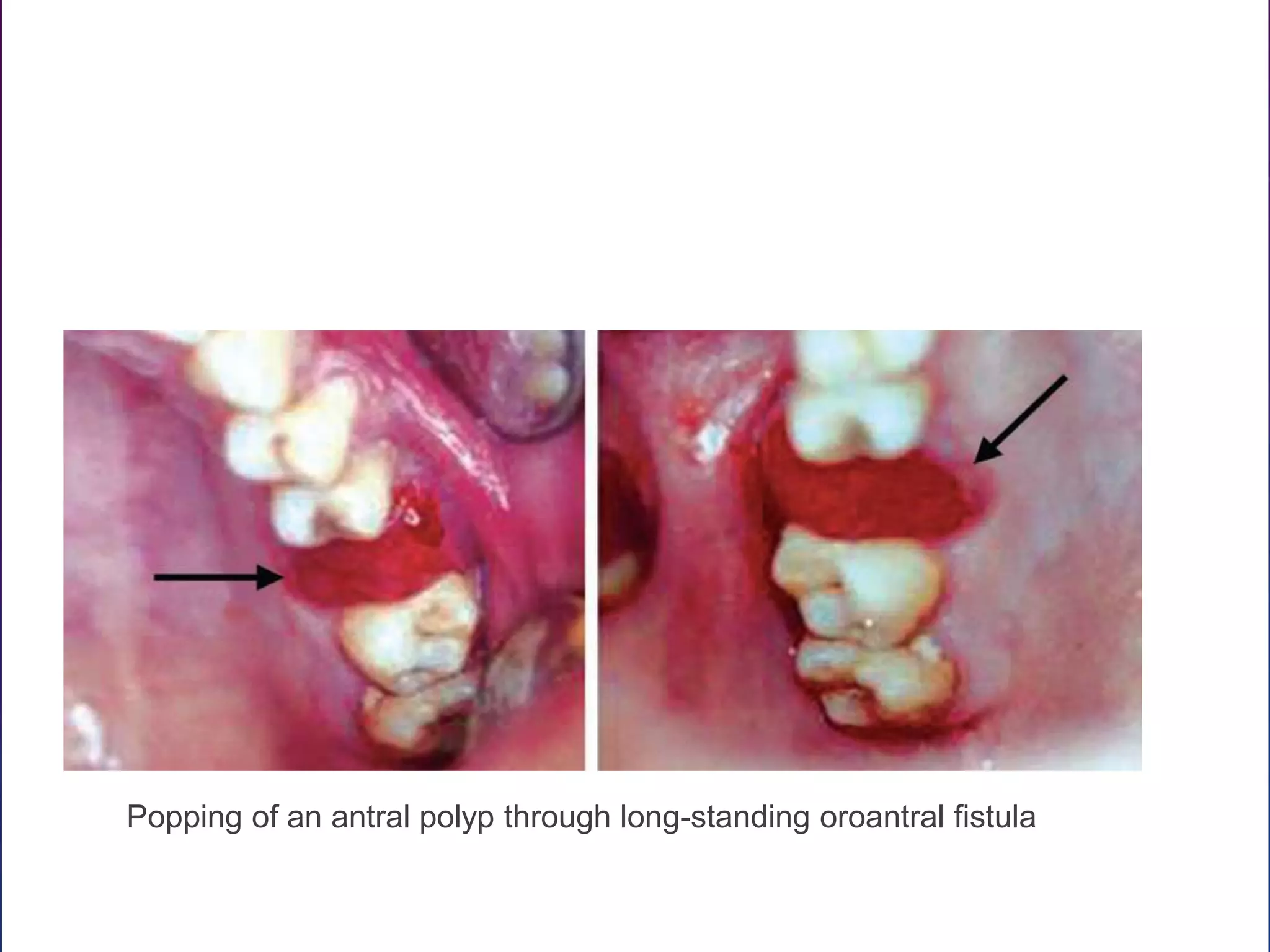 Oroantral communication & fistula | PPTX