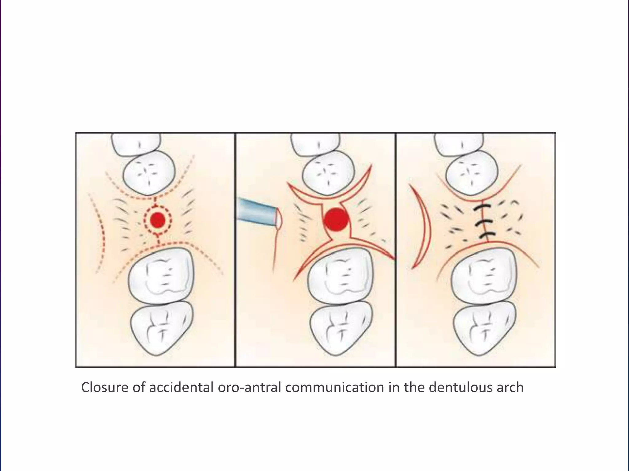 Oroantral communication & fistula | PPTX