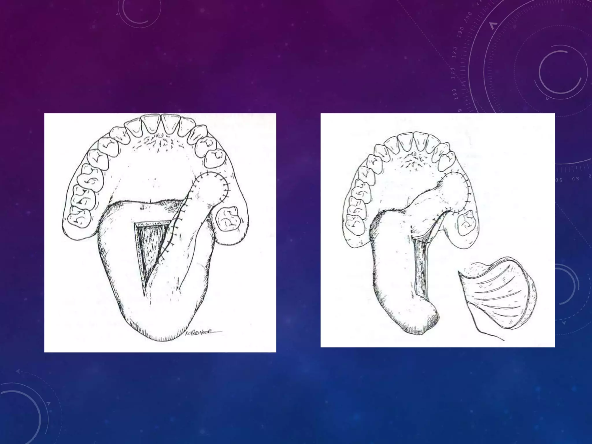 Oroantral communication & fistula | PPTX