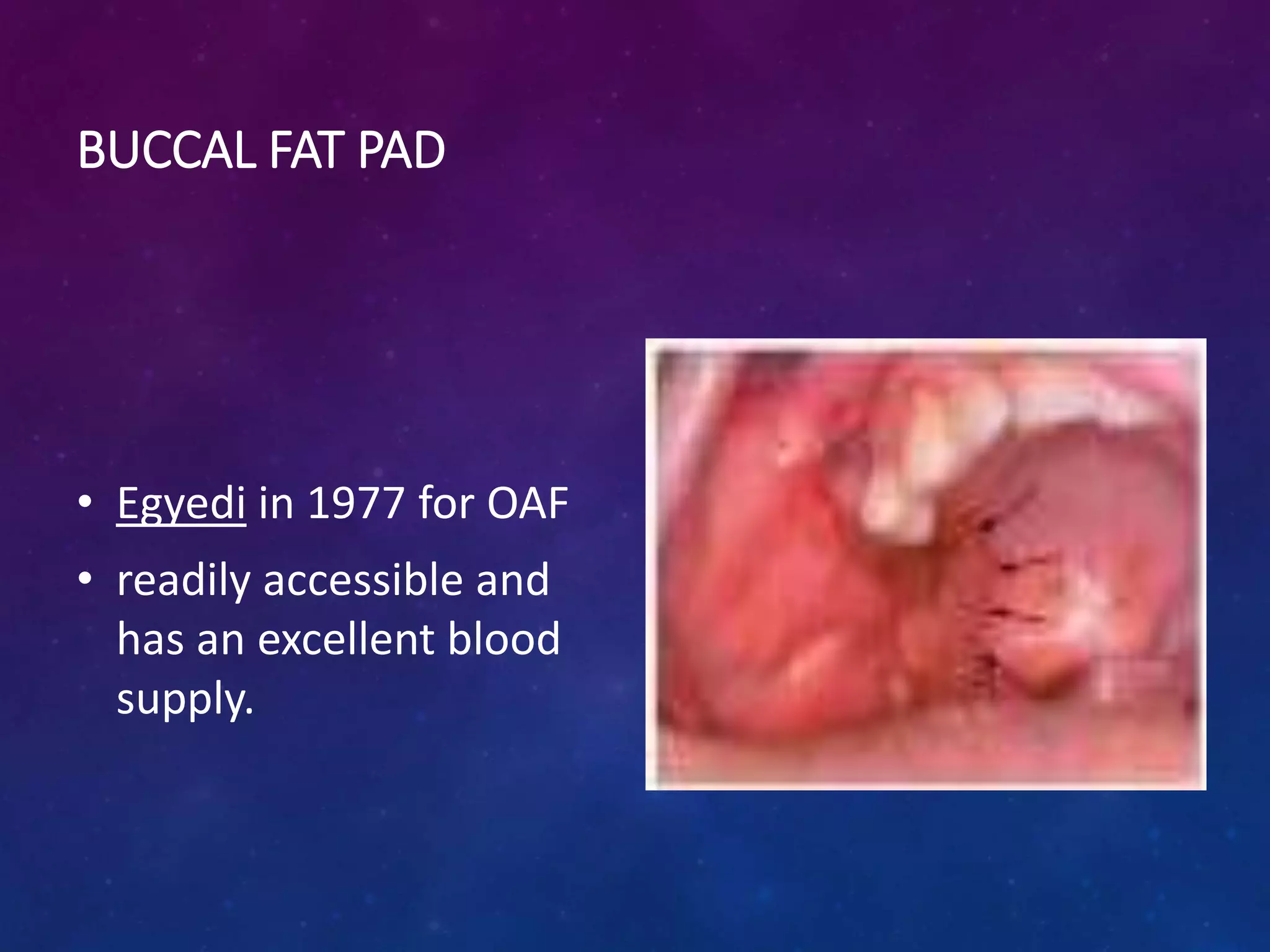 Oroantral communication & fistula | PPTX