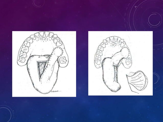 Oroantral communication & fistula | PPTX