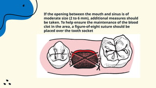Oroantral Communications.pptx‌ dental surgery | PPTX | Ear, Nose and ...