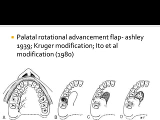 Oro antral fistula repair | PPTX