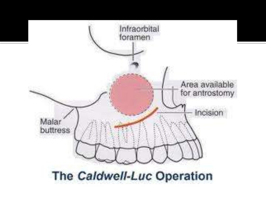 Oro antral fistula repair