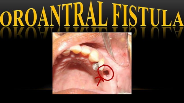 Oroantral fistula | PPT