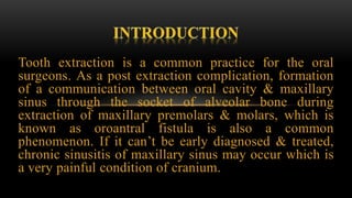 Oroantral fistula | PPTX
