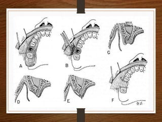 oroantralfistula1-200422165810.pptx