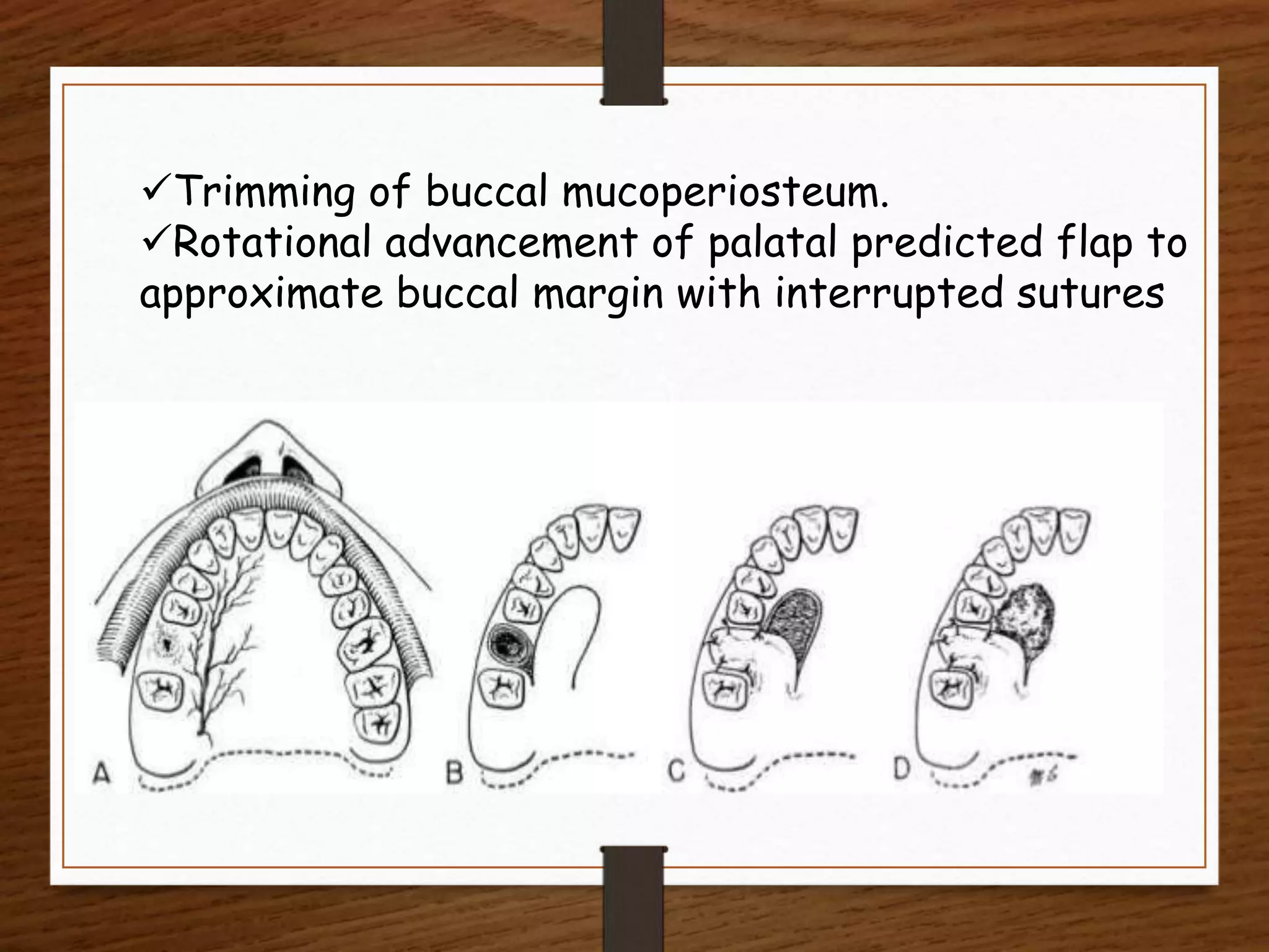 Oroantral fistula | PPTX