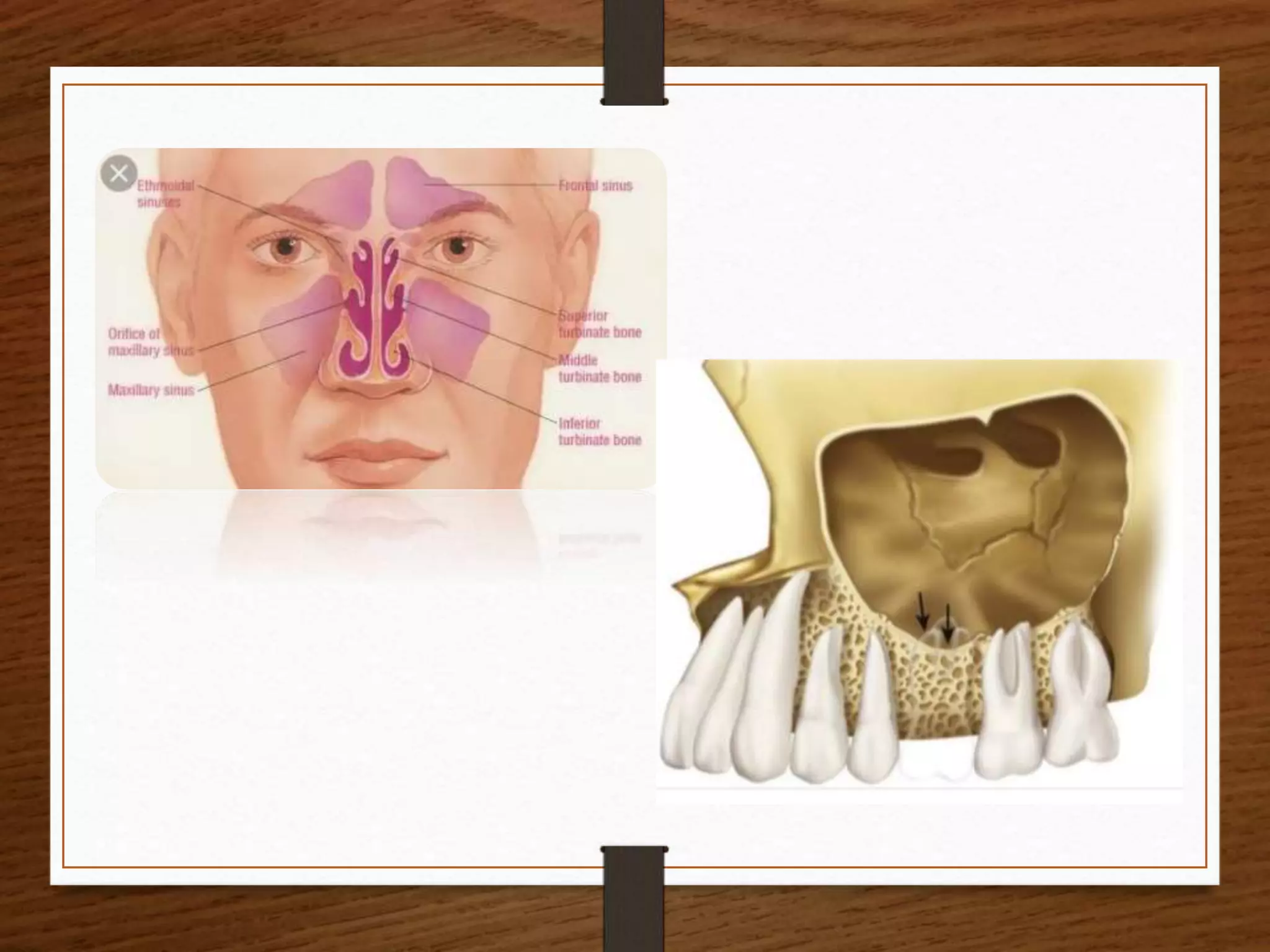 Oroantral fistula | PPTX