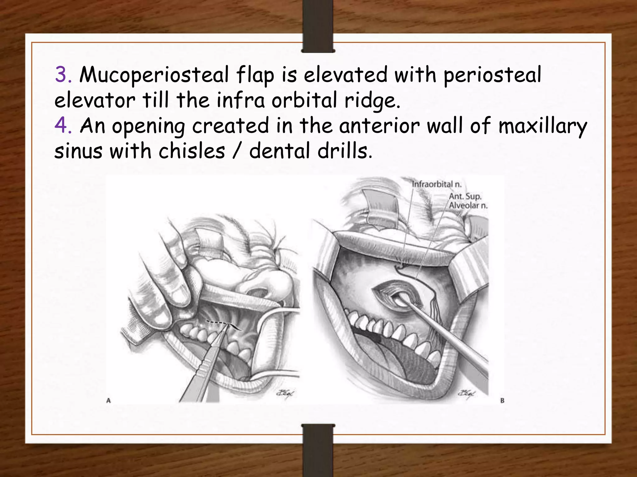 Oroantral fistula | PPTX