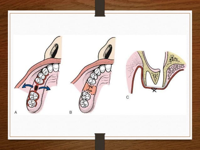 Oroantral fistula | PPTX | Ear, Nose and Throat Conditions | Diseases ...