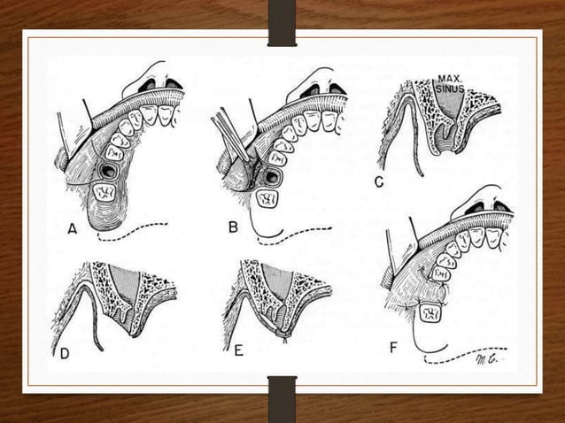 Oroantral fistula | PPTX | Ear, Nose and Throat Conditions | Diseases ...