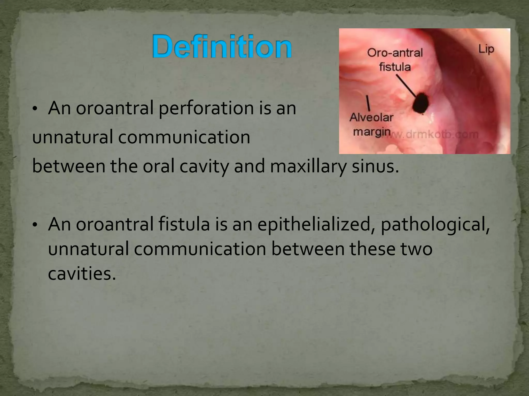 Oroantral Fistula | PPTX