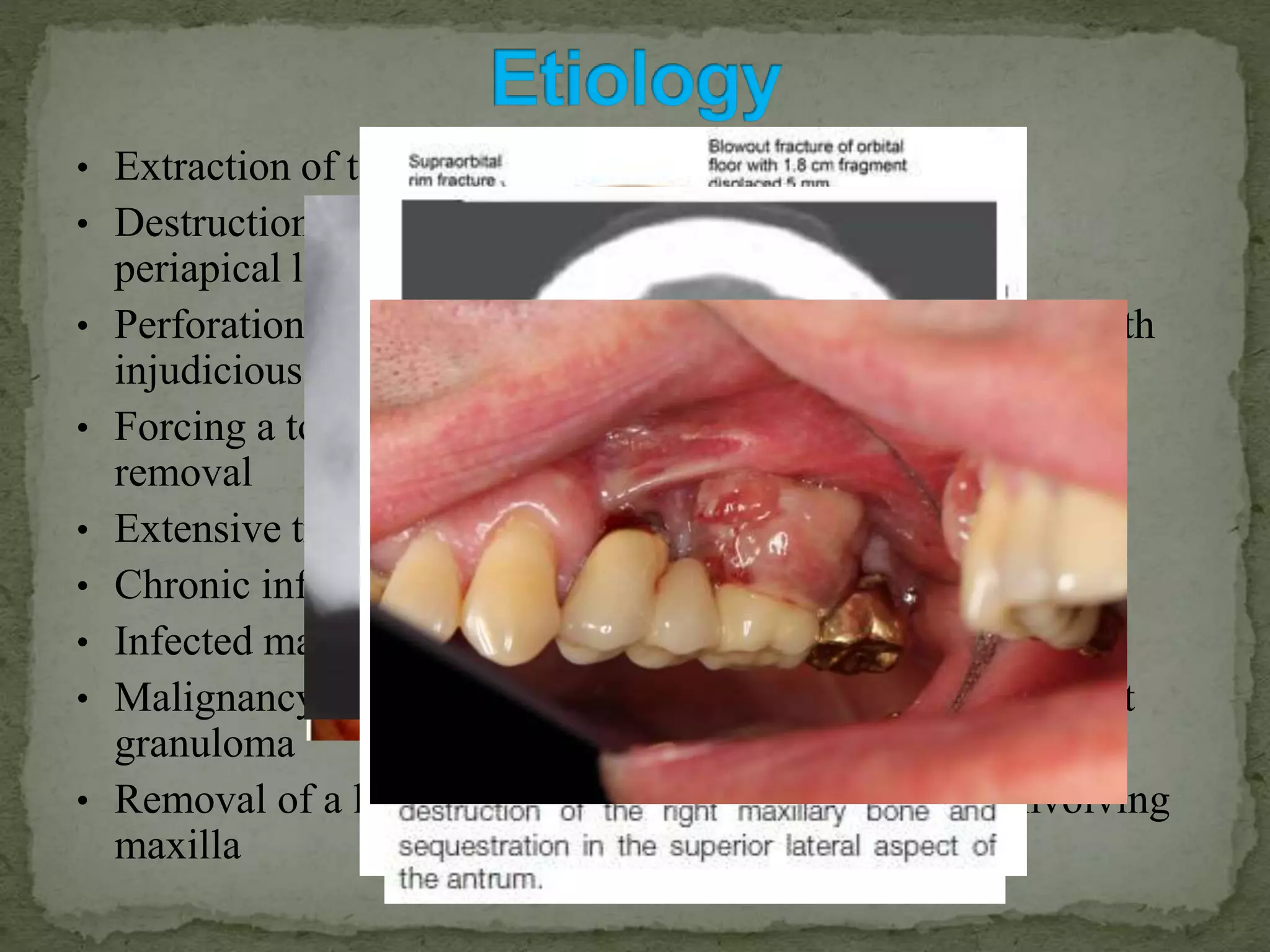 Oroantral Fistula | PPTX